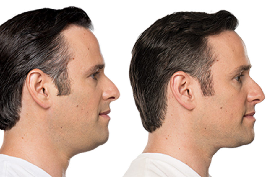 Kybella in Golden, CO | Golden Laser Aesthetics