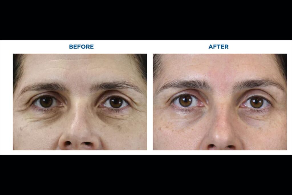 RF Microneedling in Golden, CO | Golden Laser Aesthetics