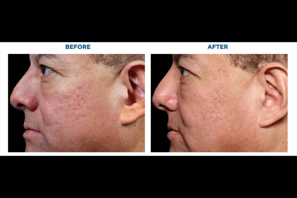 RF Microneedling in Golden, CO | Golden Laser Aesthetics